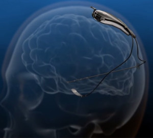 NeuroPace closes US$74 million equity funding to accelerate ...