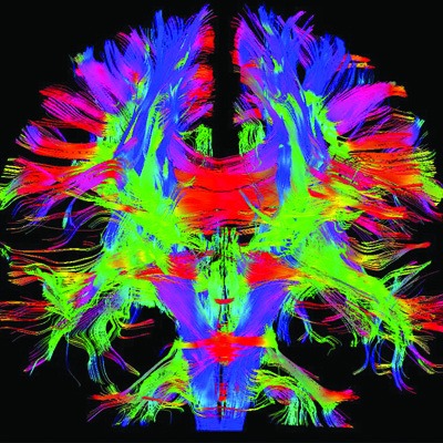 Significant milestones set in world's most detailed brain imaging study ...