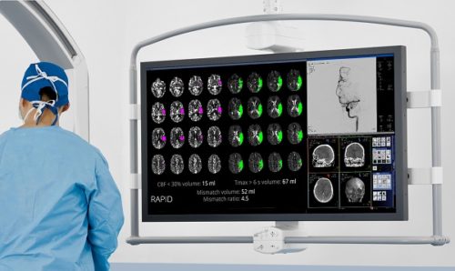 DEFUSE 3 terminated early with high likelihood of benefit in the ...