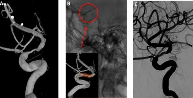 Are drug-coated balloons and drug-eluting stents the future in ...