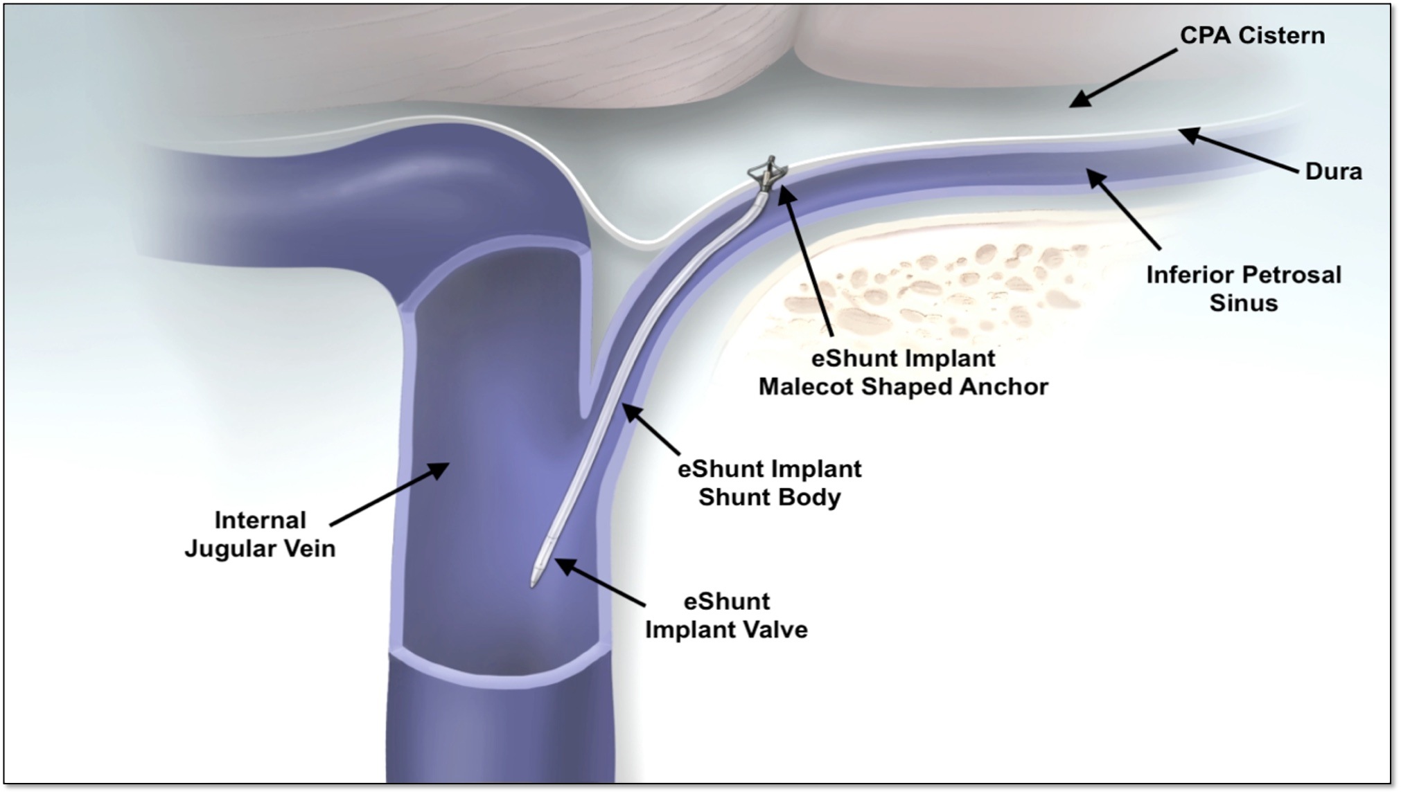 First patient treated in eShunt clinical trial - NeuroNews International