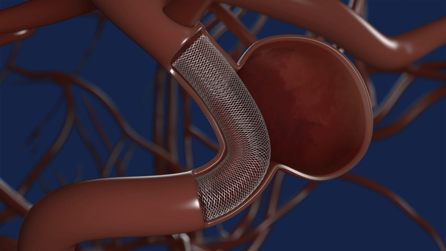 FDA approves Medtronic Pipeline Flex with Shield Technology to treat ...