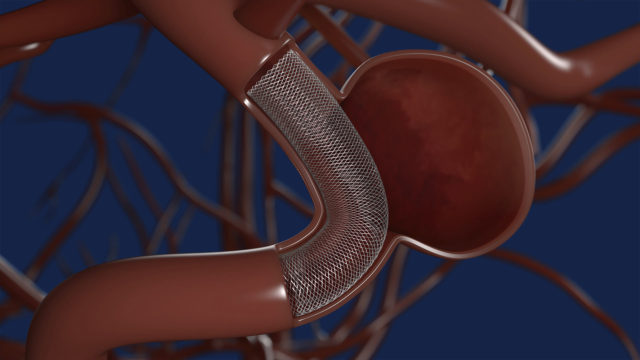 FDA approves Medtronic Pipeline Flex with Shield Technology to treat ...