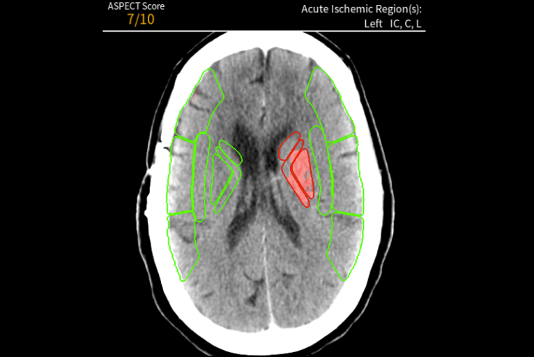 Avicenna.AI receives CE mark for AI stroke severity assessment tool