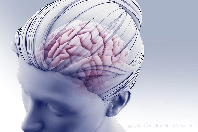 Travelling stroke team enables faster treatment, better patient outcomes