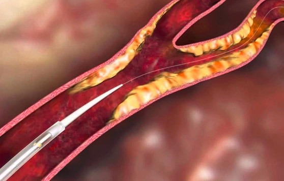 InspireMD announces the inclusion of its CGuard carotid stent in CREST-2 trial - NeuroNews ...