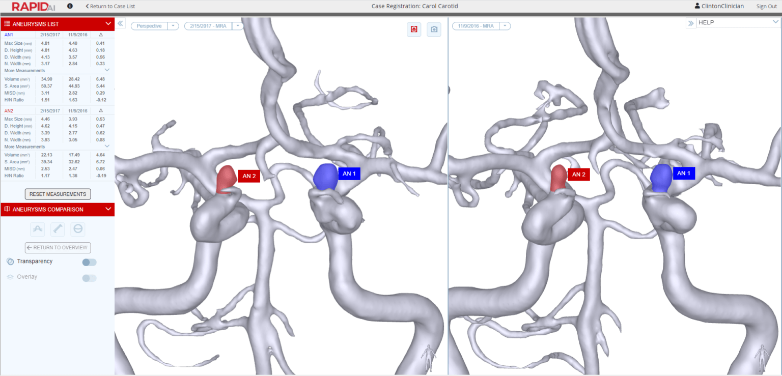 Pushing the boundaries of cerebral aneurysm detection, monitoring and ...
