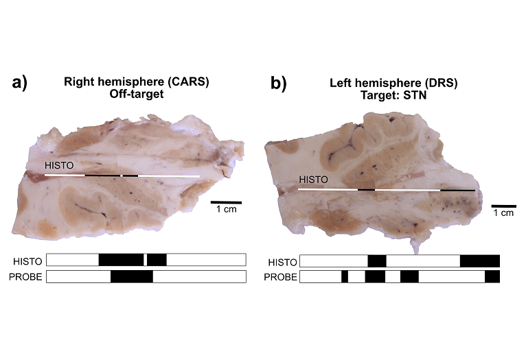 New spectroscopy probe could enhance deep brain stimulation procedures ...