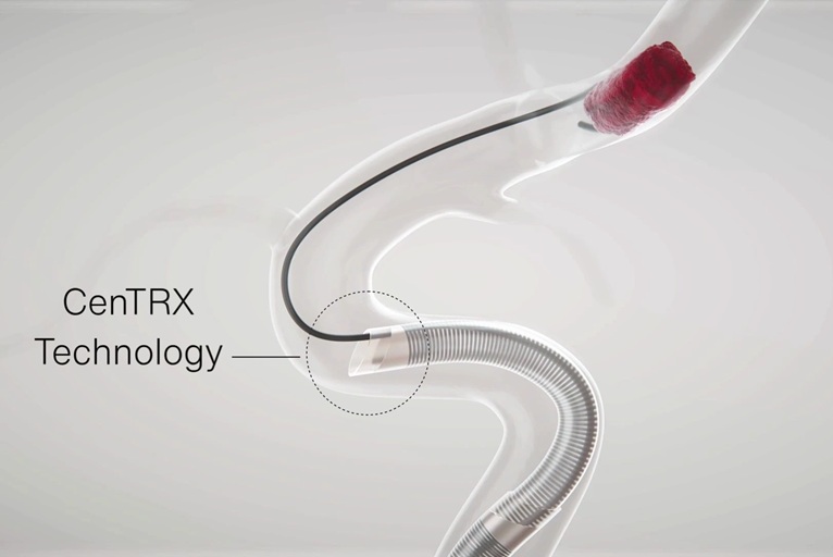 Imperative Care secures US FDA clearance for Zoom 7X catheter alongside ...